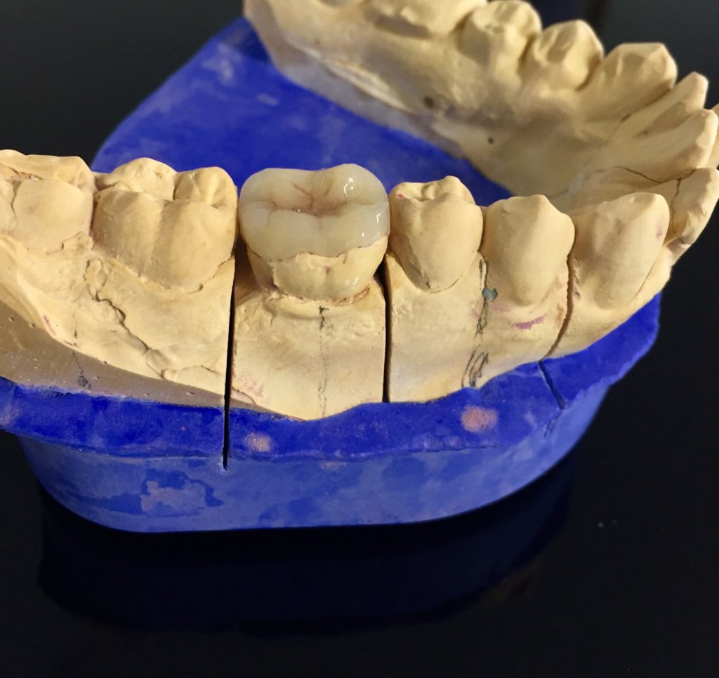 Incrustaciones - Inicio